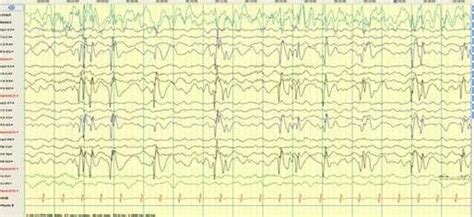 Routine Eeg Longitudinal Bipolar Montage Showing Frequent Occipital