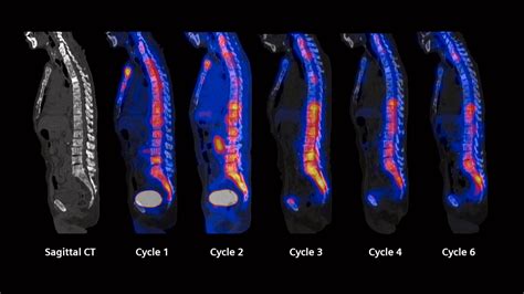 Fast Quantitative Spect Ct Acquisition Following Multiple Therapy Cycles Of 177lu Psma 617
