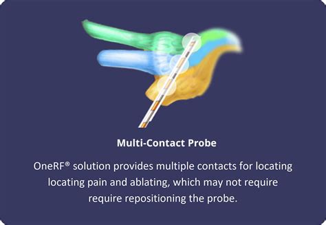 Onerf® Trigeminal Nerve Ablation System University Hospitals
