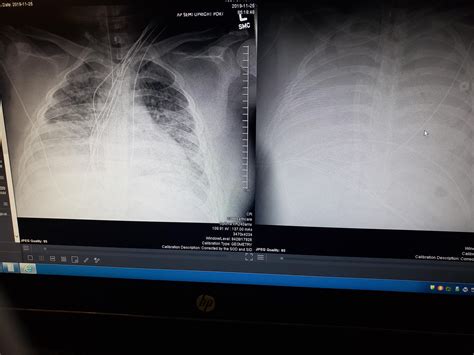 The Power Of Diuresis R Nursing