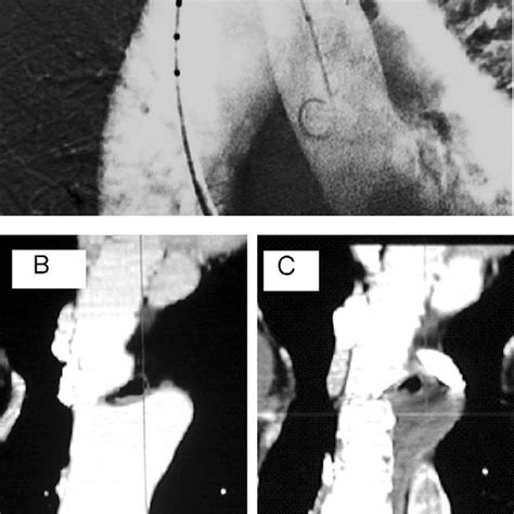 A Carotid To Subclavian Bypass B Aneurysm Before The Implants C