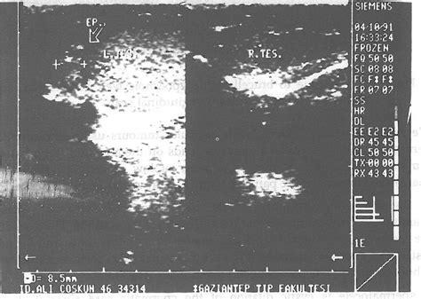 Acute Epididymitis The Epididymis Is Enlarged And There Is Swej1ing Of Download Scientific