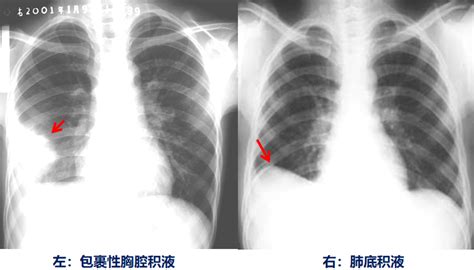 胸片胸腔积液的诊断