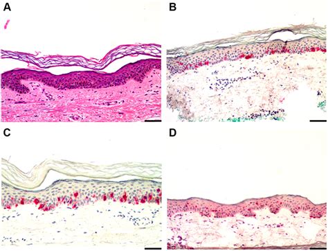 Sox 10 Hmb 45 And Melan A In Benign Melanocytic Lesions Ccid