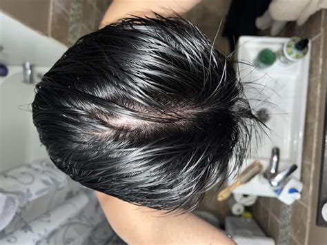 Am I Diffuse Thinning Hair Slicked Back Wet Vs Combed Forward Wet R