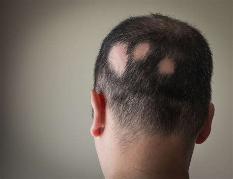 Uncover Hair Loss Causes And Solutions For Men And Women Heres How
