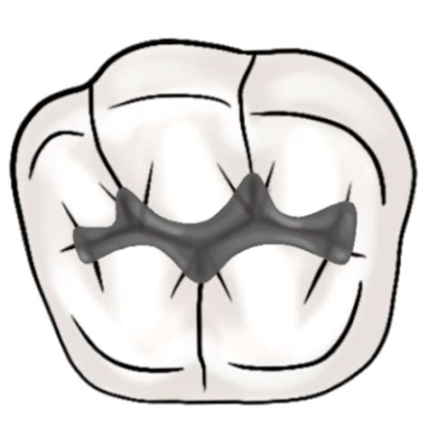 Amalgam My Dental Key