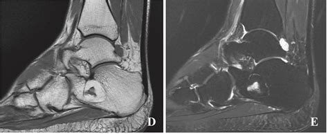 Intraosseous Calcaneal Lipoma
