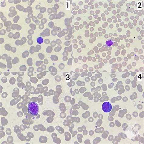 Reactive Lymphocyte Types