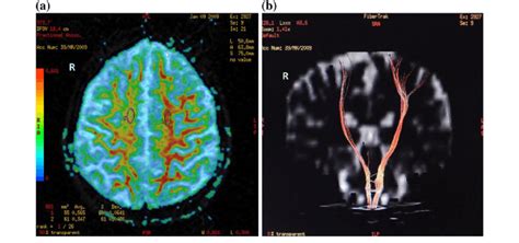 MR Diffusion Tensor Imaging DTI A Fractional Anisotropy Parametric Download Scientific