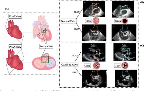 Figure 1 From Transformer Based Spatio Temporal Analysis For Classification Of Aortic Stenosis