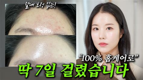 🔴100 홈케어로 7일만에 좁쌀여드름 박멸 일주일만에 여드름 속건조 장벽손상 붉은기 케어 다 잡는 방법 르누베르마켓 Youtube