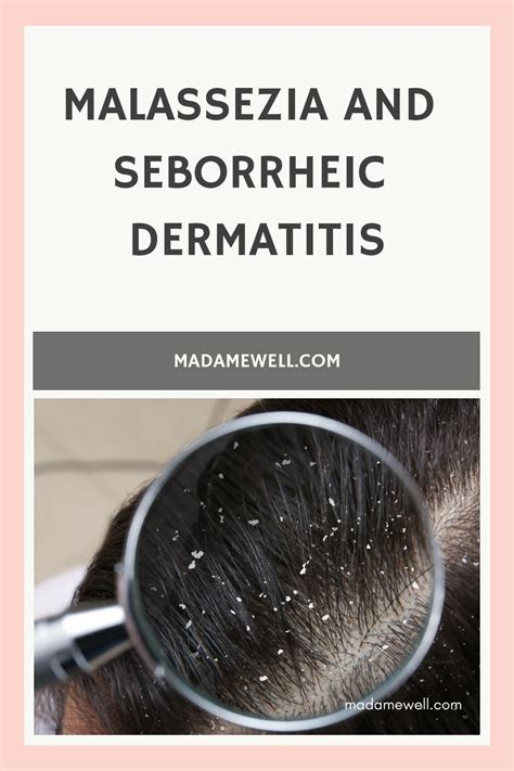 Malassezia And Seborrheic Dermatitis Getting To Know The Yeast Artofit