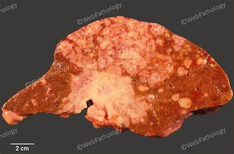 Gallbladder Carcinoma Macroscopic Features