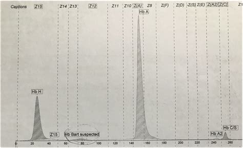 Capillary Electrophoresis Shows Predominantly Hb A Of 691 Hb A2 Of Download Scientific