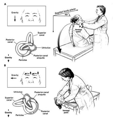 Dix Hallpike Maneuver Rebalance Sports Medicine
