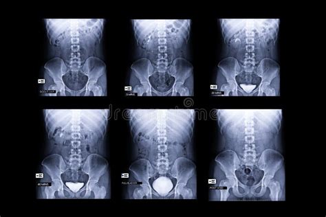 Procedure Of Intravenous Pyelogram Or I V P Stock Illustration
