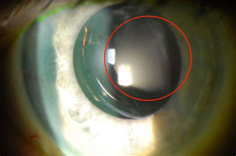 Moran Core Intraocular Lens Iol Opacification And Calcification In Patients With Hydrophilic