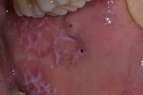 Oral Complications Of Dermatologic Disorders Atlas Of The Oral And