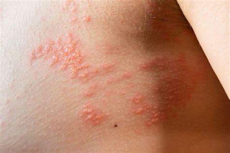Does Shingles Leave Scars Your Questions Answered Thewellthieone