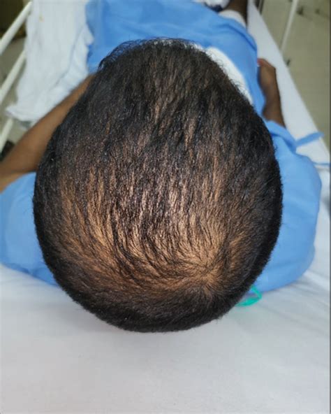 Guidelines Based Management Of Androgenetic Alopecia Cosmoderma