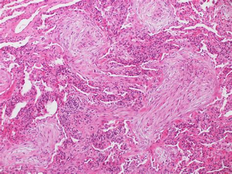 Cryptogenic Organizing Pneumonia Cop The Larger Structur Flickr