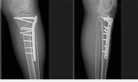 X Ray Of The Left Proximal Tibia Showing Anteroposterior And Lateral