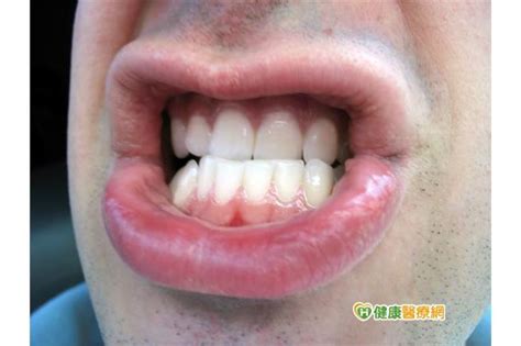 口腔潰瘍原因症狀是什麼、怎麼辦？中醫四種治療法 名家 三立新聞網 Setncom