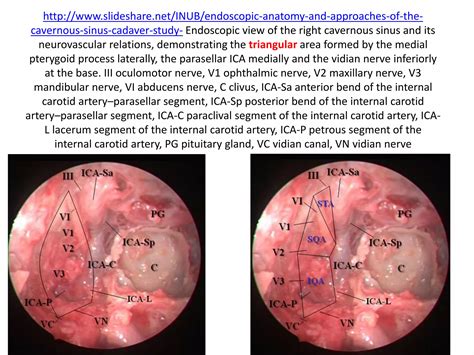 Cavernous Sinus 360° Ppt