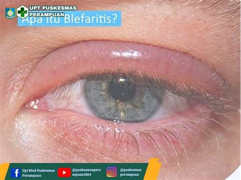 Puskesmas Gunungsari Blefaritis