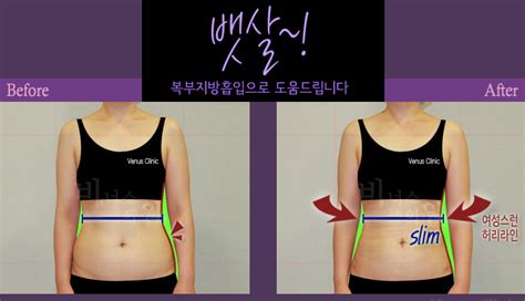 지방흡입전문 비너스의원 뱃살 빼기 고민하지말고 복부 슬림하게~