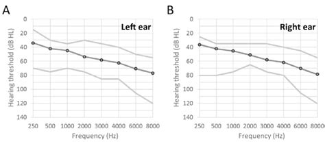 Pure Tone Audiometric Thresholds Db Hl Across Participants Plotted Download Scientific