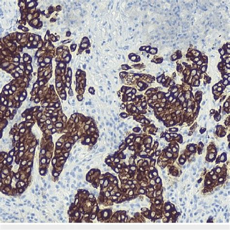 Ck7 Testing Showing Positive Ck7 Which Is Typically Positive In Ck7 Testing Showing Positive Ck7 Which Is Typically Positive In