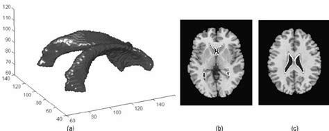 An Example Of The Mri Volume Segmentation By Three Dimensional