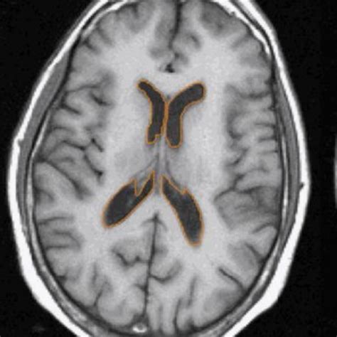 Brain Tumor Segmentation Skull Stripped Kaggle