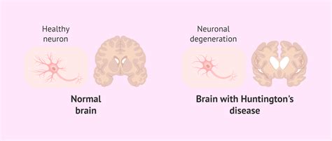 Picks Disease Vs Huntingtons Disease At Lisa Travis Blog