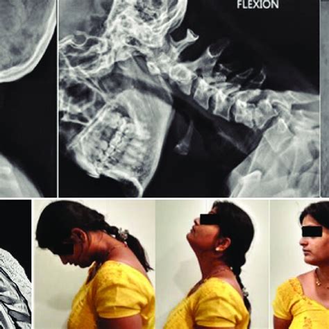 A Magnetic Resonance Imaging At Presentation Showing C5 C6 Download Scientific Diagram