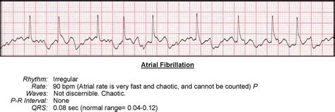 Arrhythmias Meaning Causes Symptoms Diagnosis Ecg And Treatment
