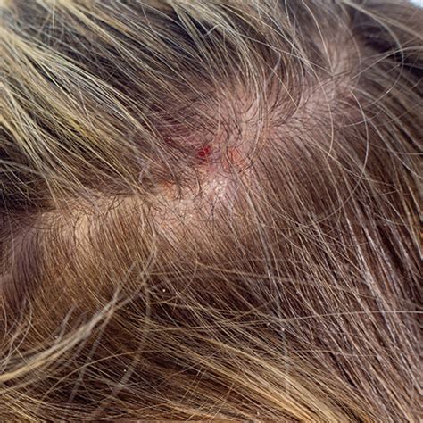 Scalp Cellulitis