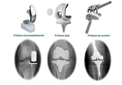 Prótesis De Rodilla Qué Es Causas Síntomas Tratamiento Y Consejos