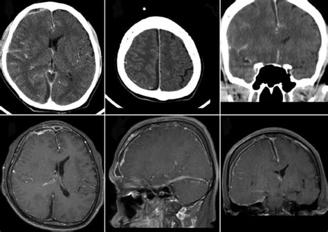 Subdural Empyema At Right Frontal Convexity And Along Right Side Falx Download Scientific