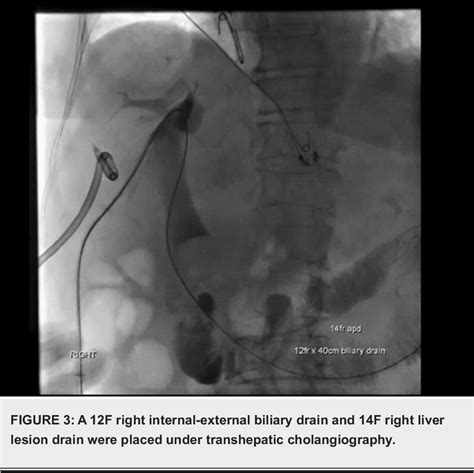 Pdf Challenging Management Of Acute Cholangitis In A Patient With