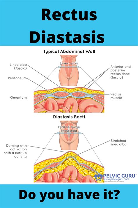 Understanding The Causes Of Rectus Diastasis Artofit