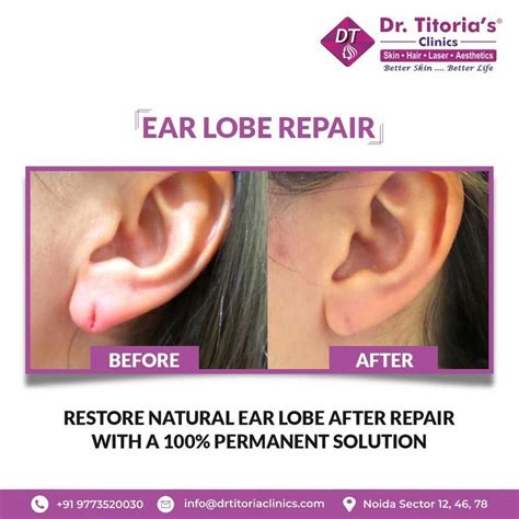 Experience The Permanent Ear Lobe Repair Reconstructive Surgery With