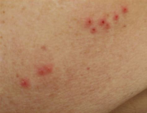 Bedbug Infestation Aafp