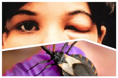 Deadly Face Biting Kissing Bug Closing In On New York State