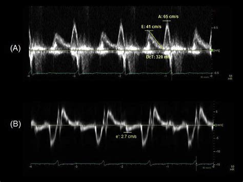 A Pulsed Doppler Echocardiography At The Mitral Inflow Showed An E Download Scientific