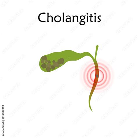 Gallbladder Disease Inflammation Gallstone Blocks Common Bile Duct Cholangitis Anatomy Gallbladder Disease Inflammation Gallstone Blocks Common Bile Duct Cholangitis Anatomy