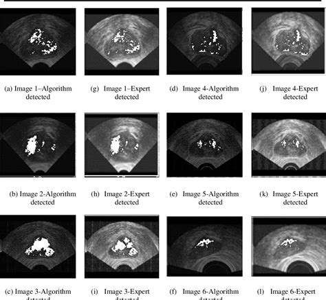 Figure 1 From Detection Of Prostate Cancer Using Radialaxial Scanning Of 2d Trans Rectal