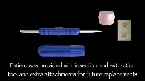 Maxillary Tooth Supported Overdenture With Mandibular Cast Partial